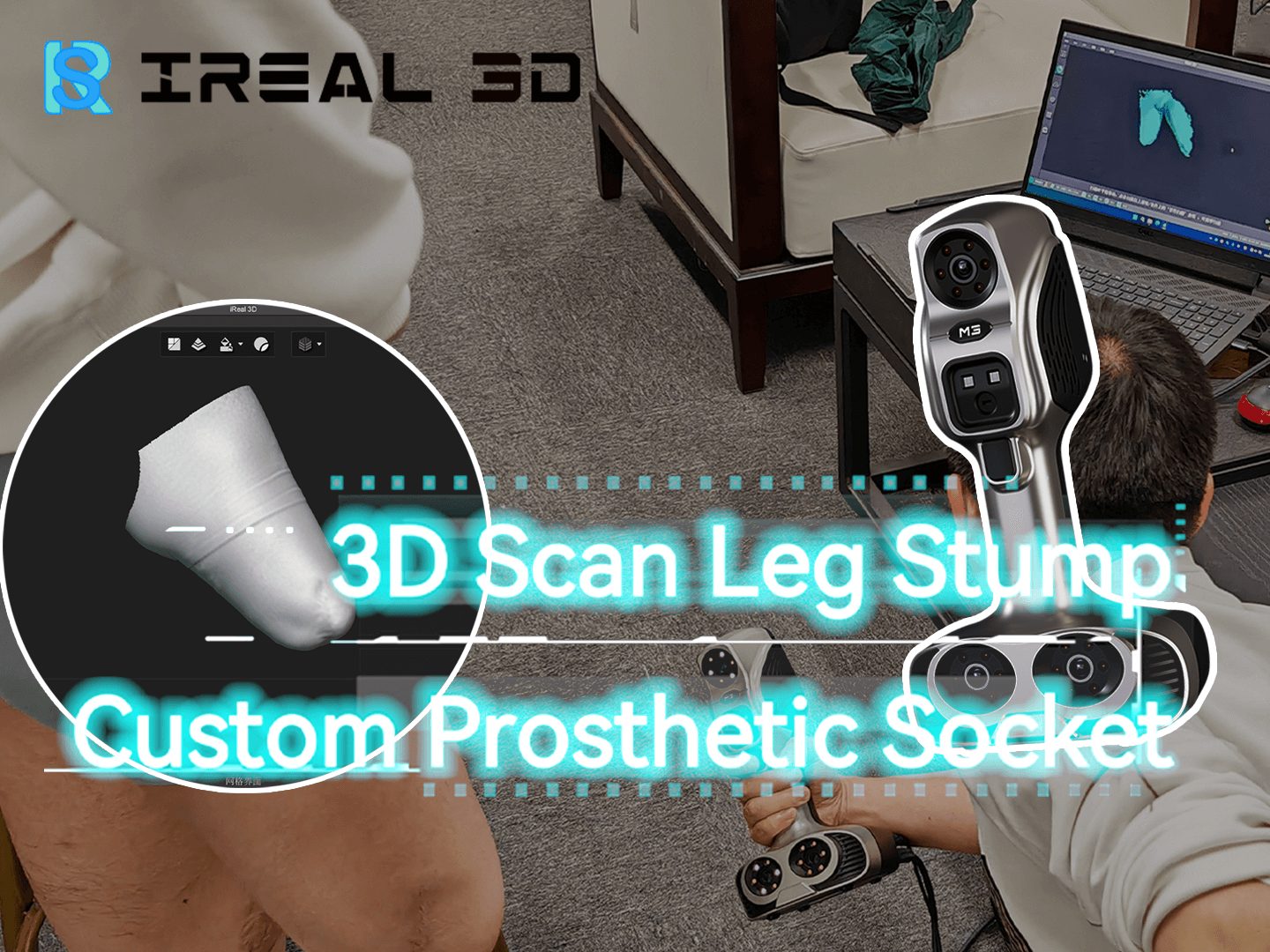 3DeVOK Scanning Helps 3D-Printed Prosthetic Socket Customization - 3DeVOK