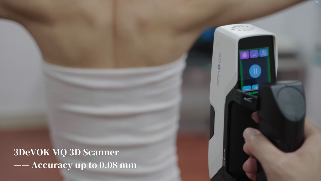 3DeVOK MQ 3D Scanning + TPM3D 3D Printing: Making Scoliosis Correction No Longer "One-Size-Fits ...